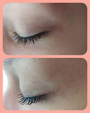LASHLIFT FILLER | ΚΕΝΤΡΑ ΑΙΣΘΗΤΙΚΗΣ ΘΕΣΣΑΛΟΝΙΚΗ